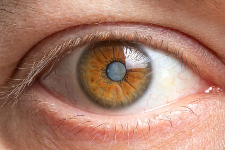 Cataracts and Aging: What You Need to Know About Age-Related Vision ...